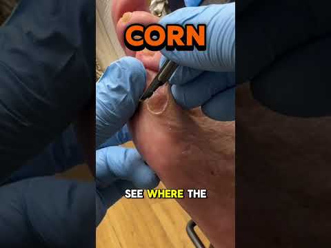 👣 Case Spotlight: Fifth Toe Corn Debridement This patient presented wi ...
