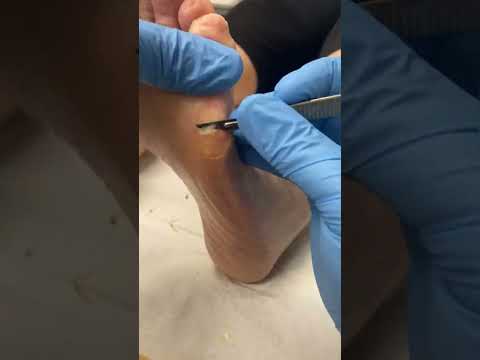 Transform your feet with this ultimate hard skin removal! Watch as a s ...