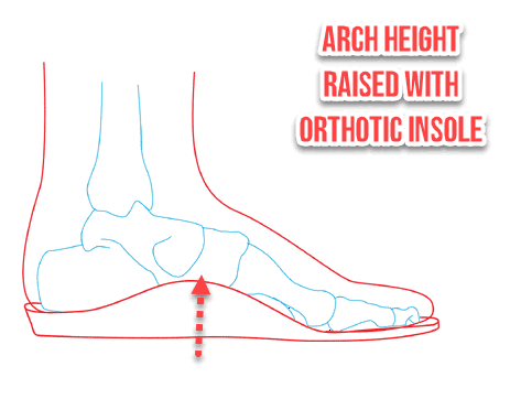 Orthotic Insoles for Plantar Fasciitis - Arch support and Cushioned ...